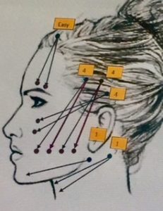 Jowl lift with MINT threads - Weinstein Plastic Surgery Center